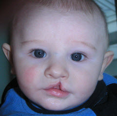 Treatment for Cleft Palate Speech Disorders - Speech Buddies
