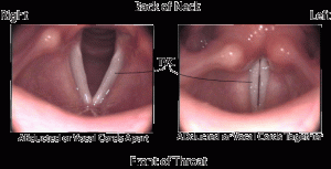 Speech Therapy for Paradoxical Vocal Fold Movement – Disorders in Children